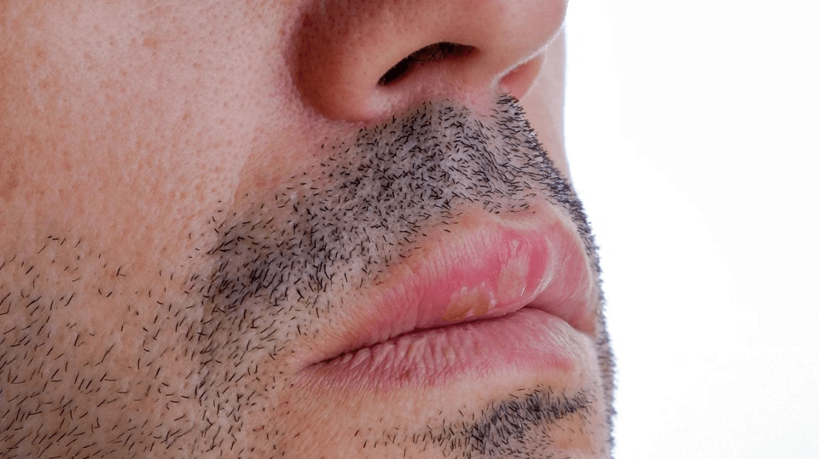 Blisters: Visual Guide, Causes, and Prognosis | № 10082 | Sexual Wellness