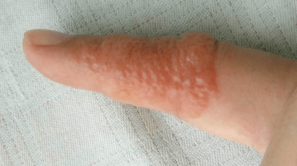 Blisters: Visual Guide, Causes, and Prognosis | № 10082 | Sexual Wellness