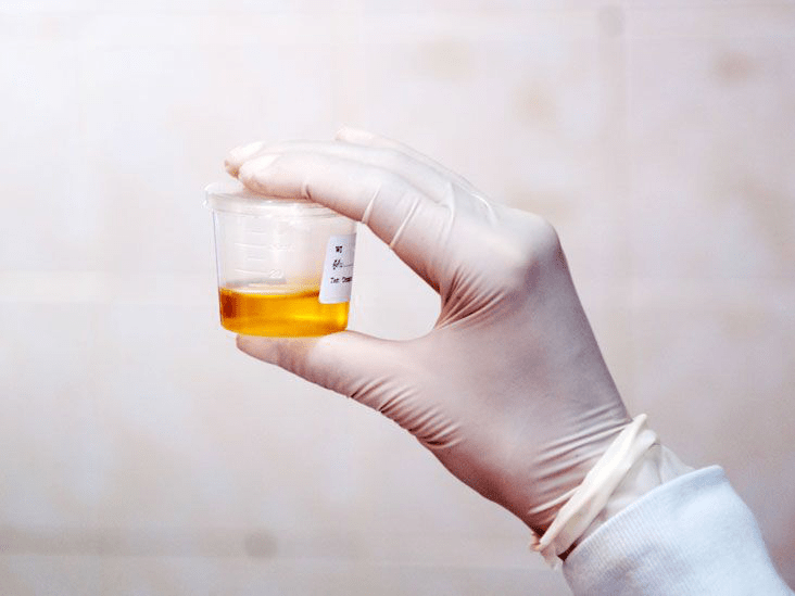 2025 Creatinine Urine Test Guide: Cost, Preparation & Result ...