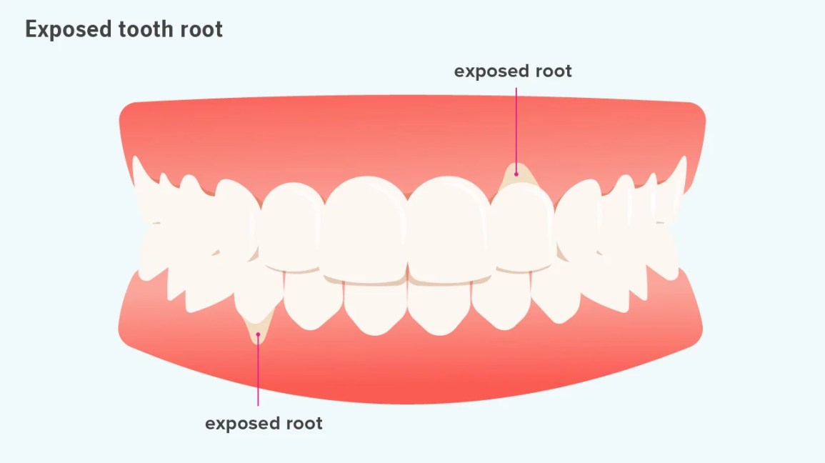2025 Guide: Exposed Tooth Root Symptoms, Causes & Treatments Starting ...