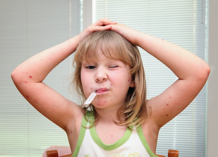 How to Recognize Chickenpox Symptoms in Adults and Children | № 69757 ...