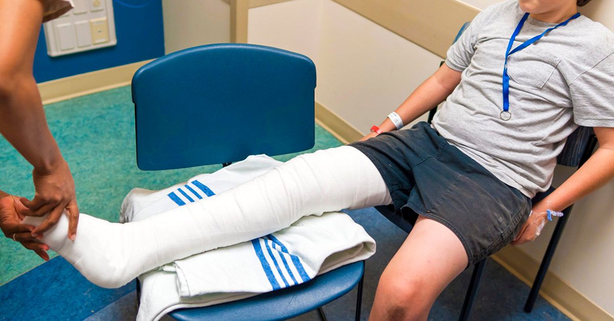 Broken Femur: Causes, Treatments, and Potential Complications Explained ...