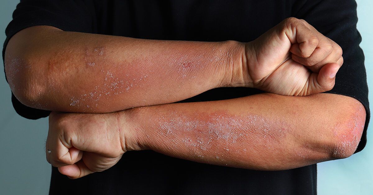 Recognizing Mild, Moderate, and Severe Psoriasis: Key Signs and ...