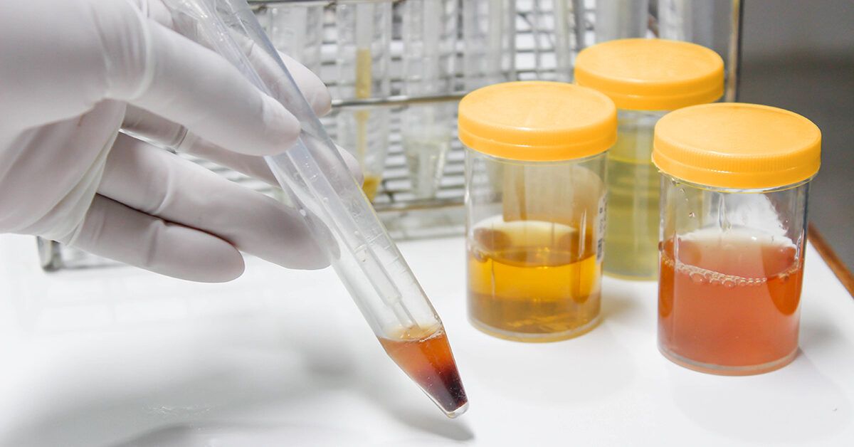 Understanding Urine Color Changes in Kidney Failure: Key Signs to ...